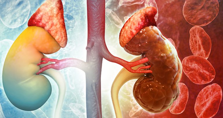 Cáncer de Riñón | MSO